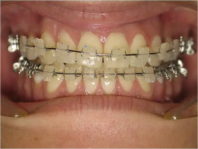 Before and After Pictures of Jaw Surgery | Oral Surgery Boca & Delray