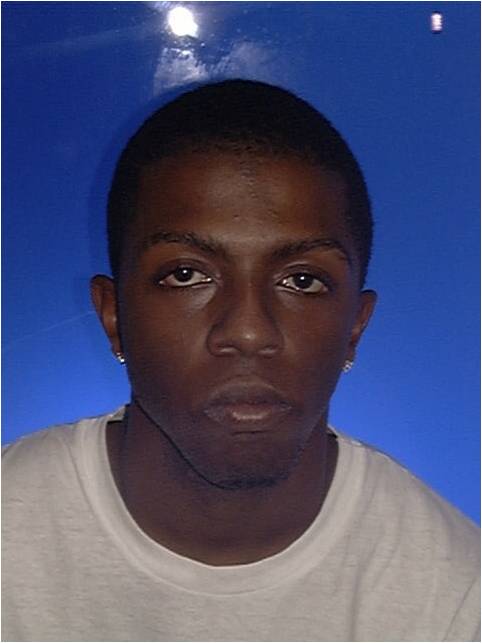 Before and After Pictures of Jaw Surgery | Oral Surgery Boca & Delray