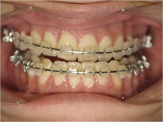Before and After Pictures of Jaw Surgery | Oral Surgery Boca & Delray