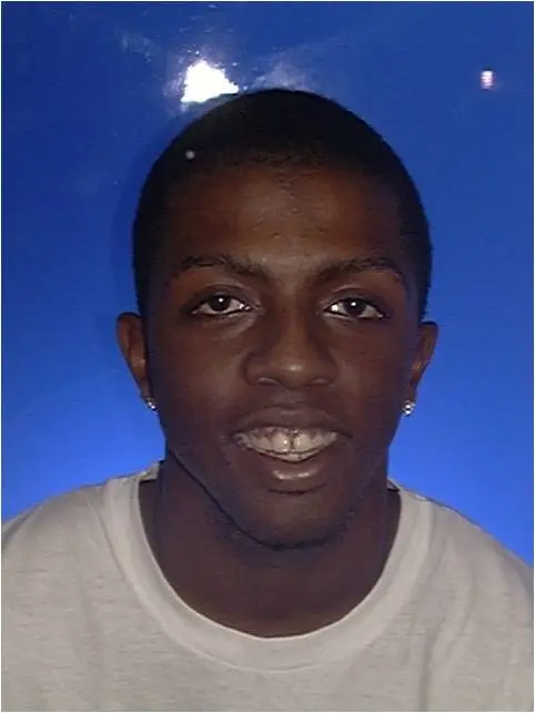 Before and After Pictures of Jaw Surgery | Oral Surgery Boca & Delray