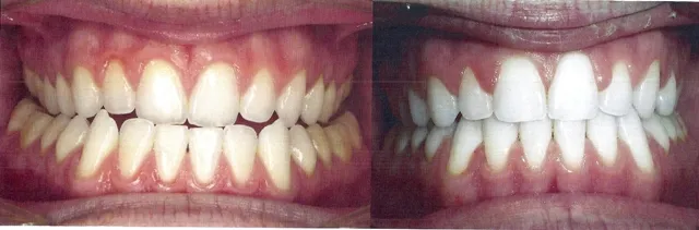 Before and After Pictures of Jaw Surgery | Oral Surgery Boca & Delray