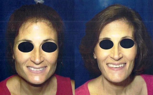 Before and After Pictures of Jaw Surgery | Oral Surgery Boca & Delray