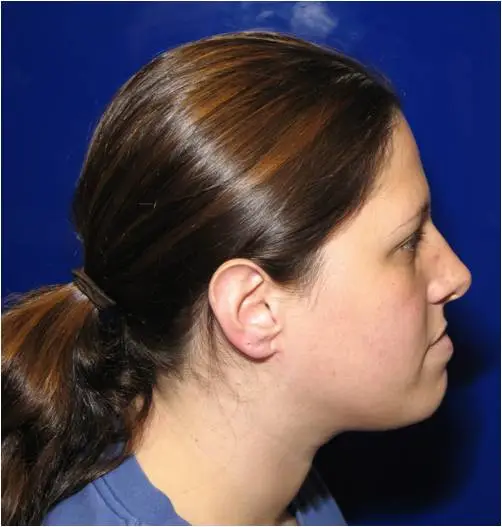 Before and After Pictures of Jaw Surgery | Oral Surgery Boca & Delray