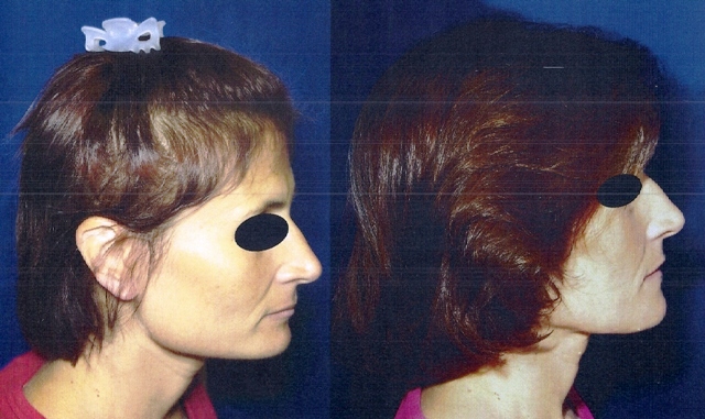 Before and After Pictures of Jaw Surgery | Oral Surgery Boca & Delray