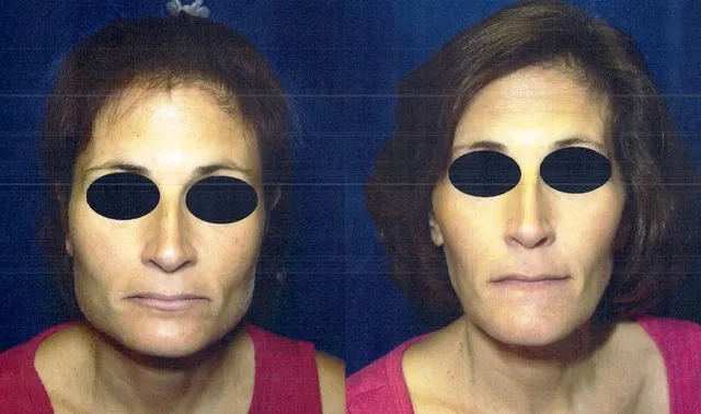 Before and After Pictures of Jaw Surgery | Oral Surgery Boca & Delray