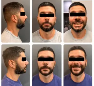 Oral Surgery Boca Raton and Delray Beach FL Boca Jaw Surgery